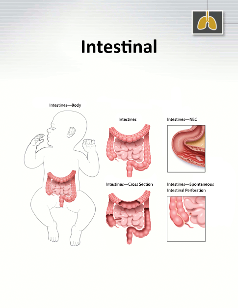 Intestinal - NICU Parent Education Resources